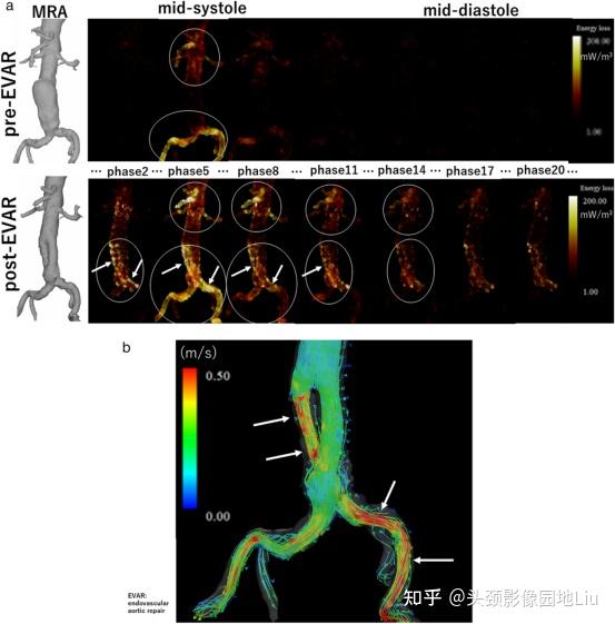 一起看懂4D FLOW MRI参数（下） - 知乎