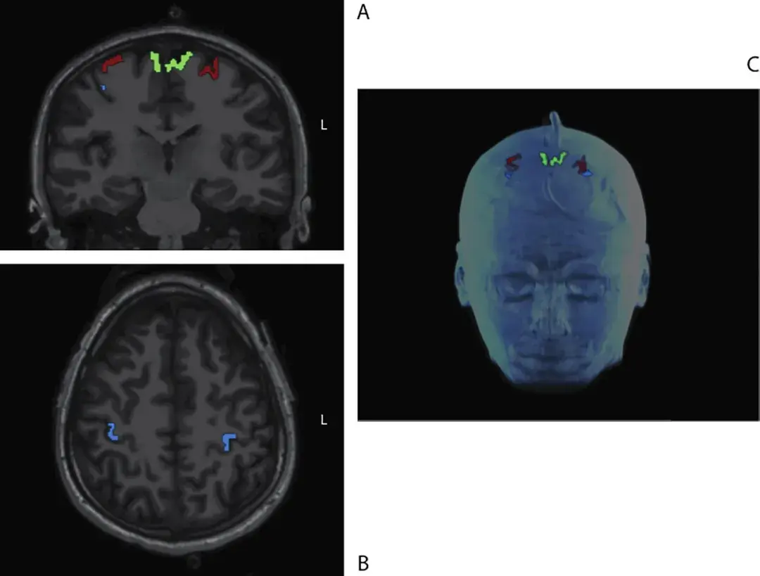 【Simpleware】经颅运动诱发电位阈值电压和电流密度的有限元模拟 - 知乎