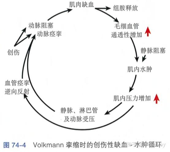 上肢骨筋膜室综合征和Volkmann挛缩 - 知乎