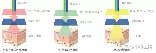 IPL、OPT、DPL是什么呢？怎么区分这些光谱？ - 知乎