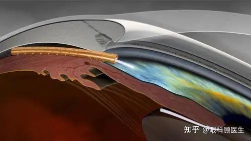 什么是青光眼MIGS手术？ - 知乎