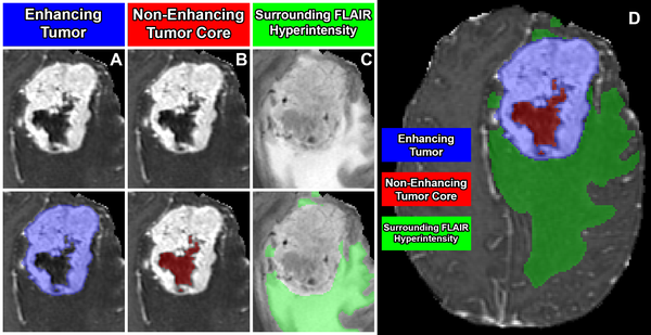 BraTS2023-MEN 数据集介绍 - 知乎