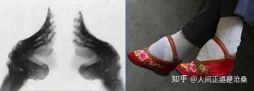Foot binding in a Ming Dynasty cemetery near Xi'an, China - 知乎