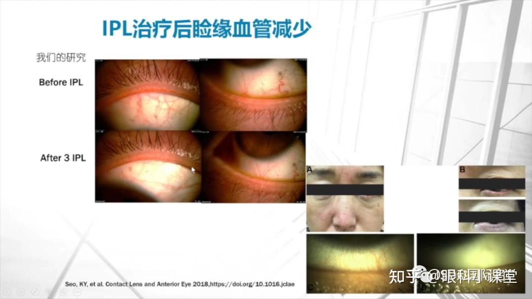 干眼系列课程 | 晏晓明教授《IPL治疗MGD的机制研究》 - 知乎