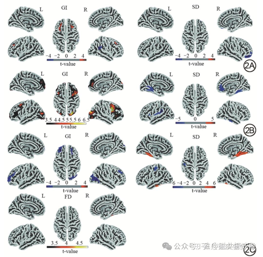 伴随可能RBD PD患者的性别特异性脑形态及网络差异研究 - 知乎