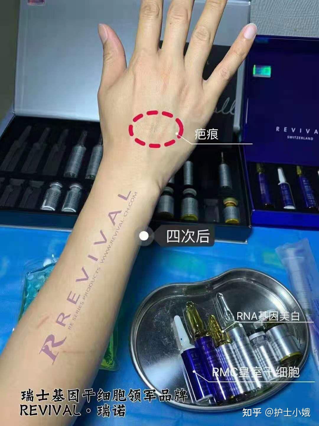 关于美白针,你需要知道的事 知乎