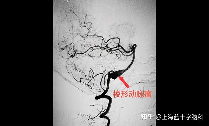 脑血管病做什么检查？专家解读：CTA、MRA、DSA - 知乎