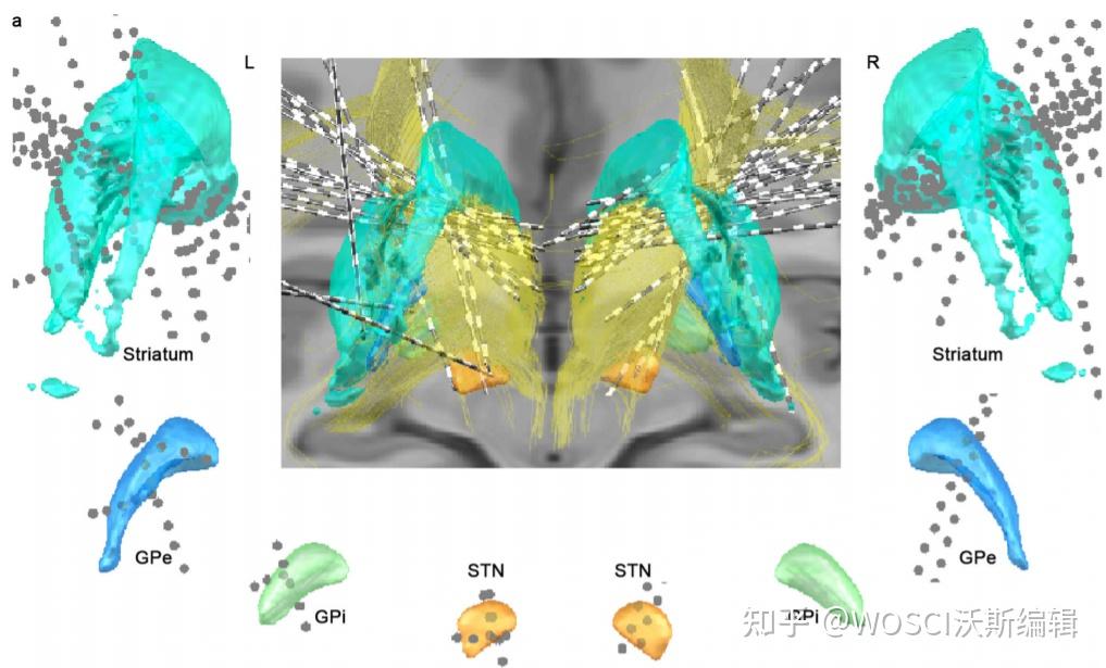 Commun Biol｜首都医科大学宣武医院癫痫团队在国际上首次直接揭示人脑基底节核团功能多样性 - 知乎