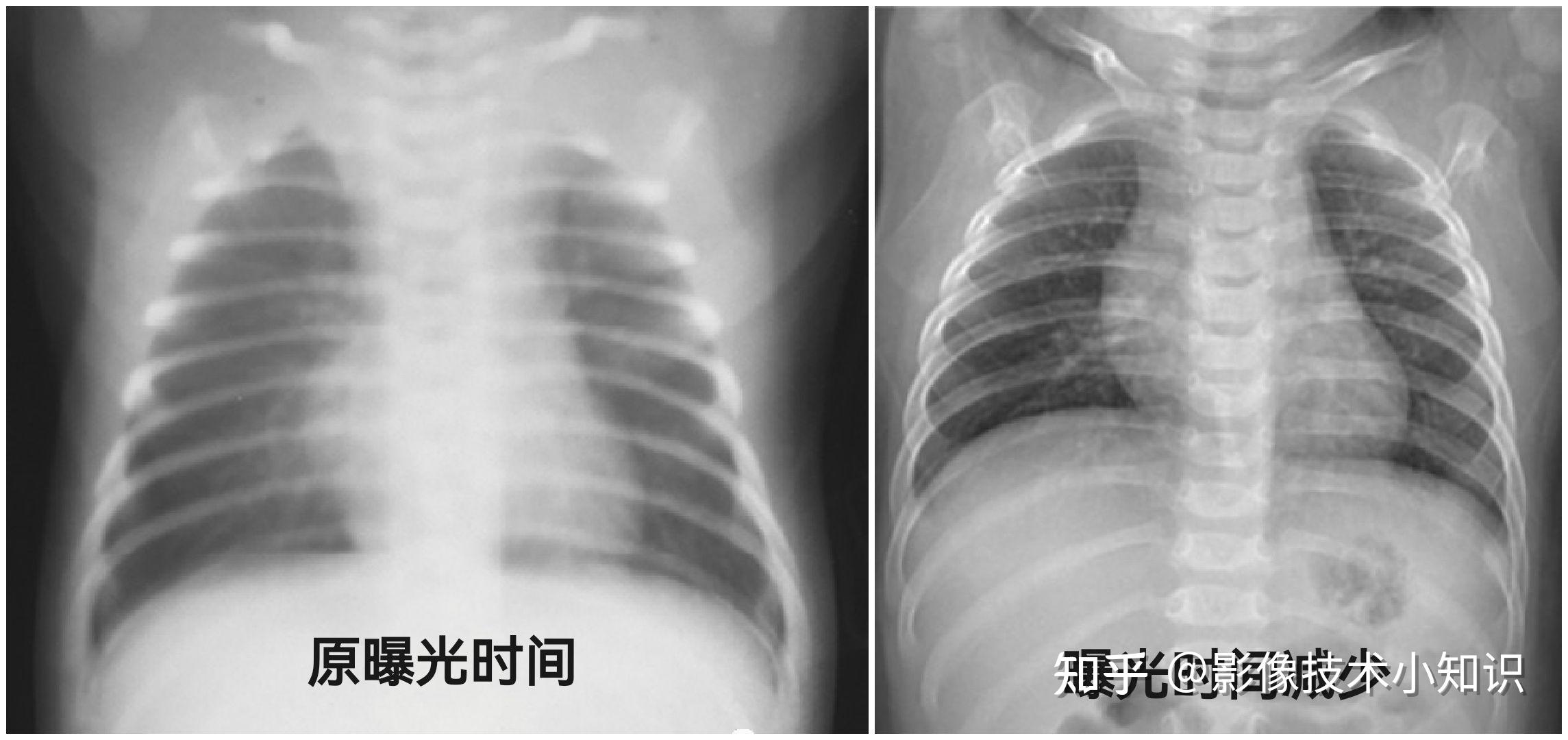 DR图像质量控制（3）-ms和光圈大小 - 知乎