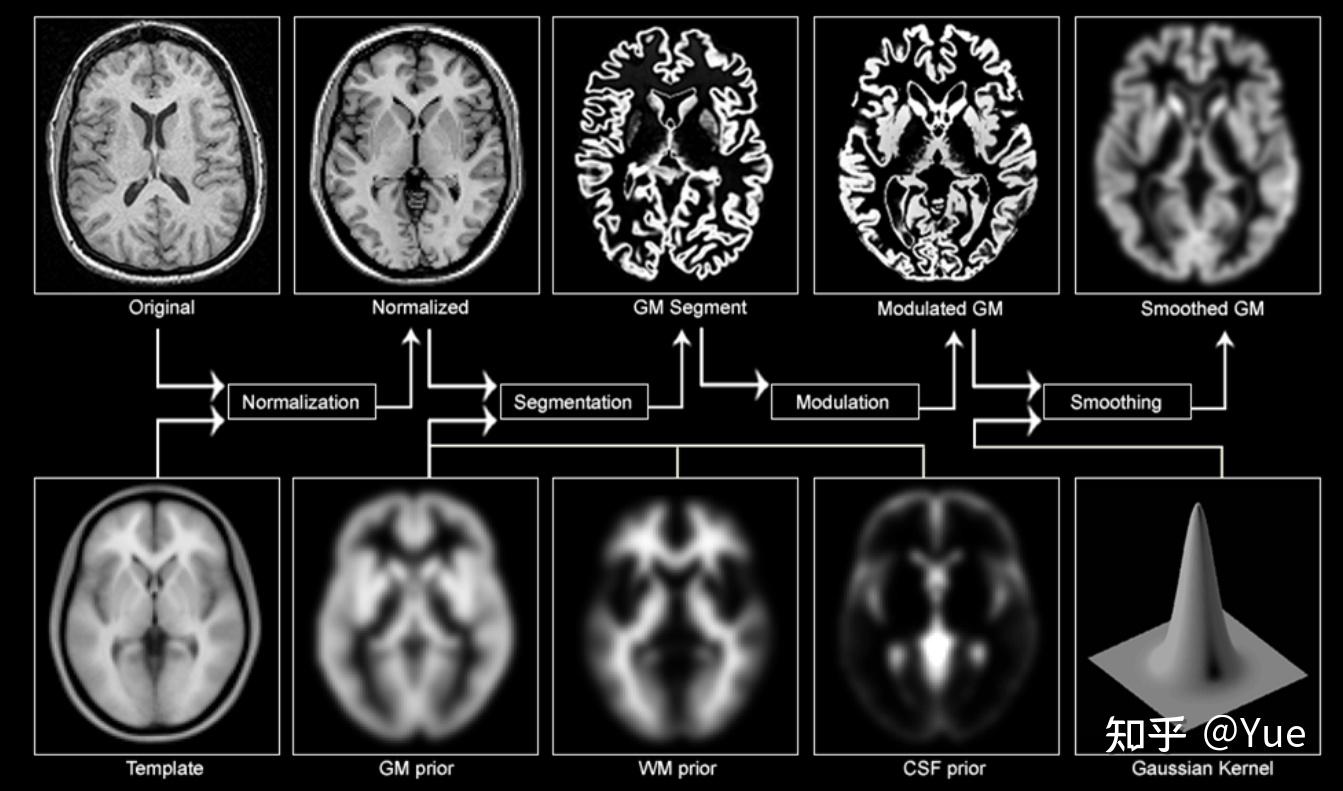 00-mri-vbm