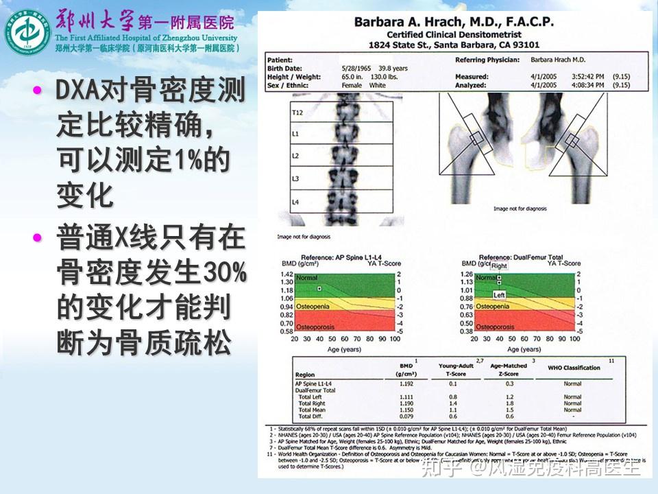 糖皮质激素性骨质疏松（GIOP）诊治进展 - 知乎