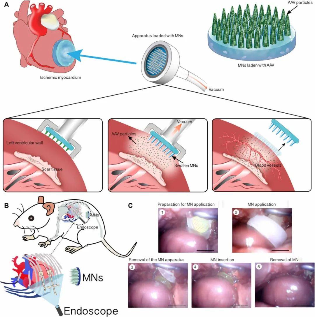 专家点评：微针介导的AAV基因疗法治疗心肌病，实现高效递送、均匀分布 - 知乎