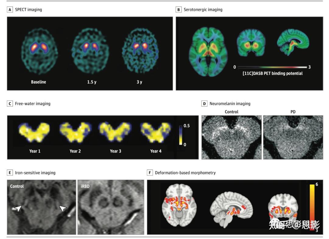JAMA Neurology：帕金森病不同疾病阶段的神经影像学生物标志物 - 知乎