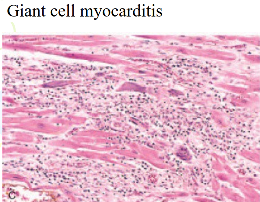 循环病理学：心肌病和心肌炎 - 知乎