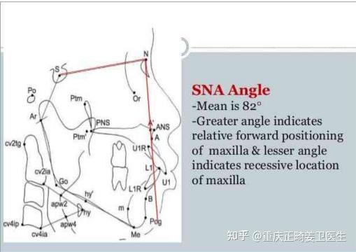 重庆牙齿矫正(正畸）|你的嘴凸是牙性还是骨性?怎么通过SNA、SNB、ANB角判断面型？