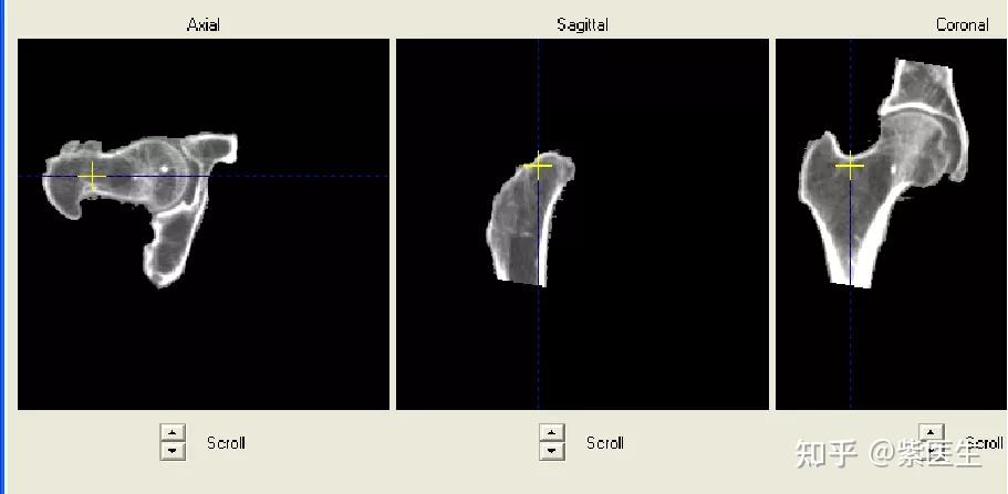 定量CT（QCT）是什么？临床应用有哪些？ - 知乎