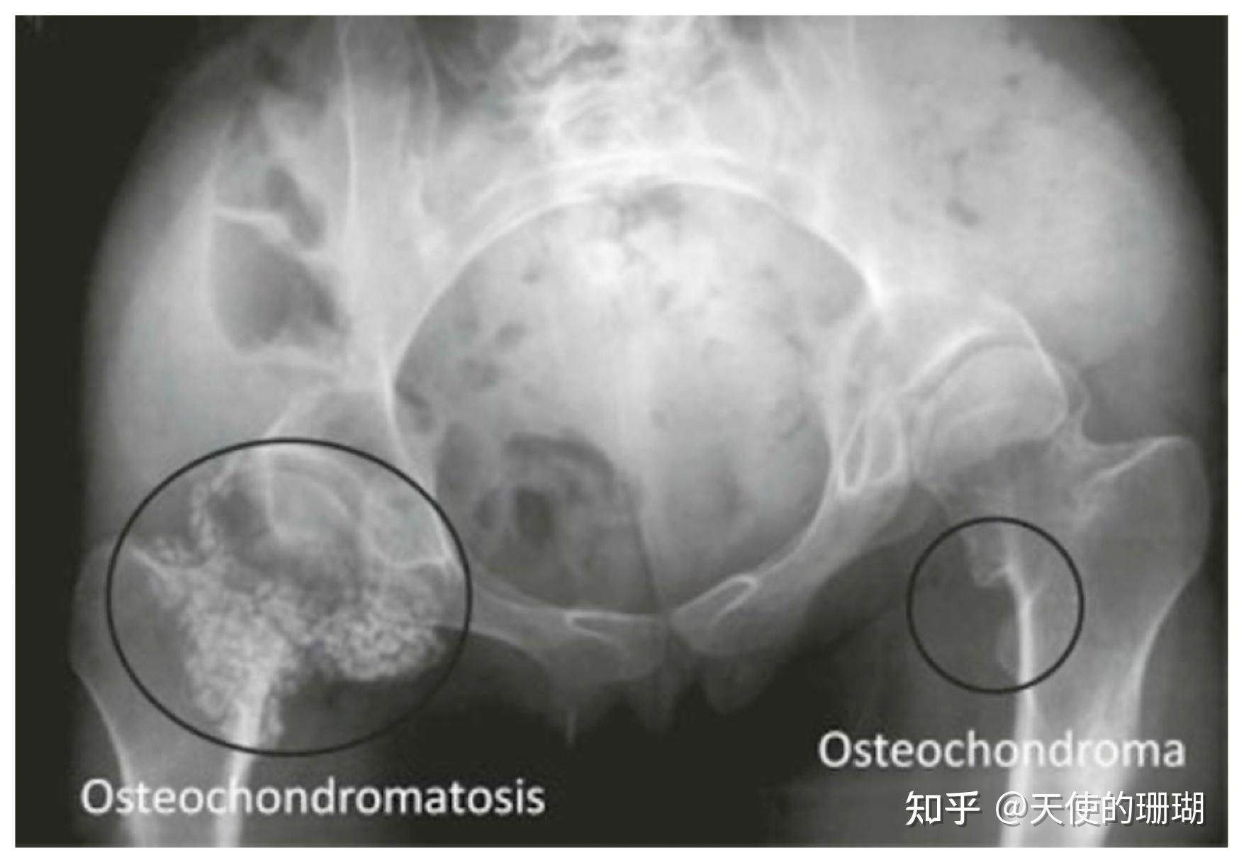 FOP中异位骨(HO)的影像学模拟评估方法 - 知乎