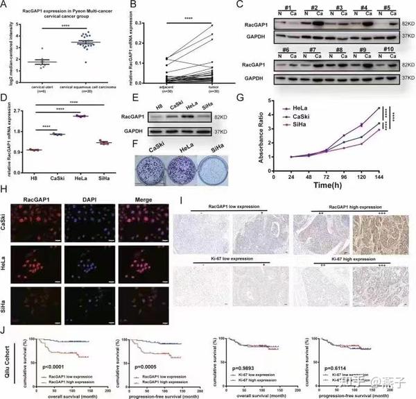 宫颈癌的潜在的新型预后标志物——Rac-GTP酶激活蛋白1（RacGAP1） - 知乎