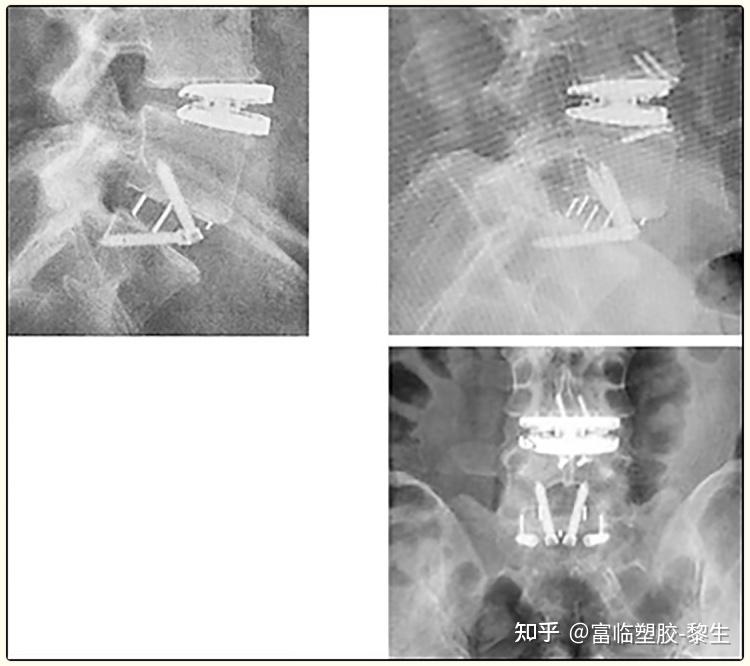 CarboSil制作腰椎和颈椎椎间盘有机硅聚碳酸酯聚氨酯共聚物 - 知乎