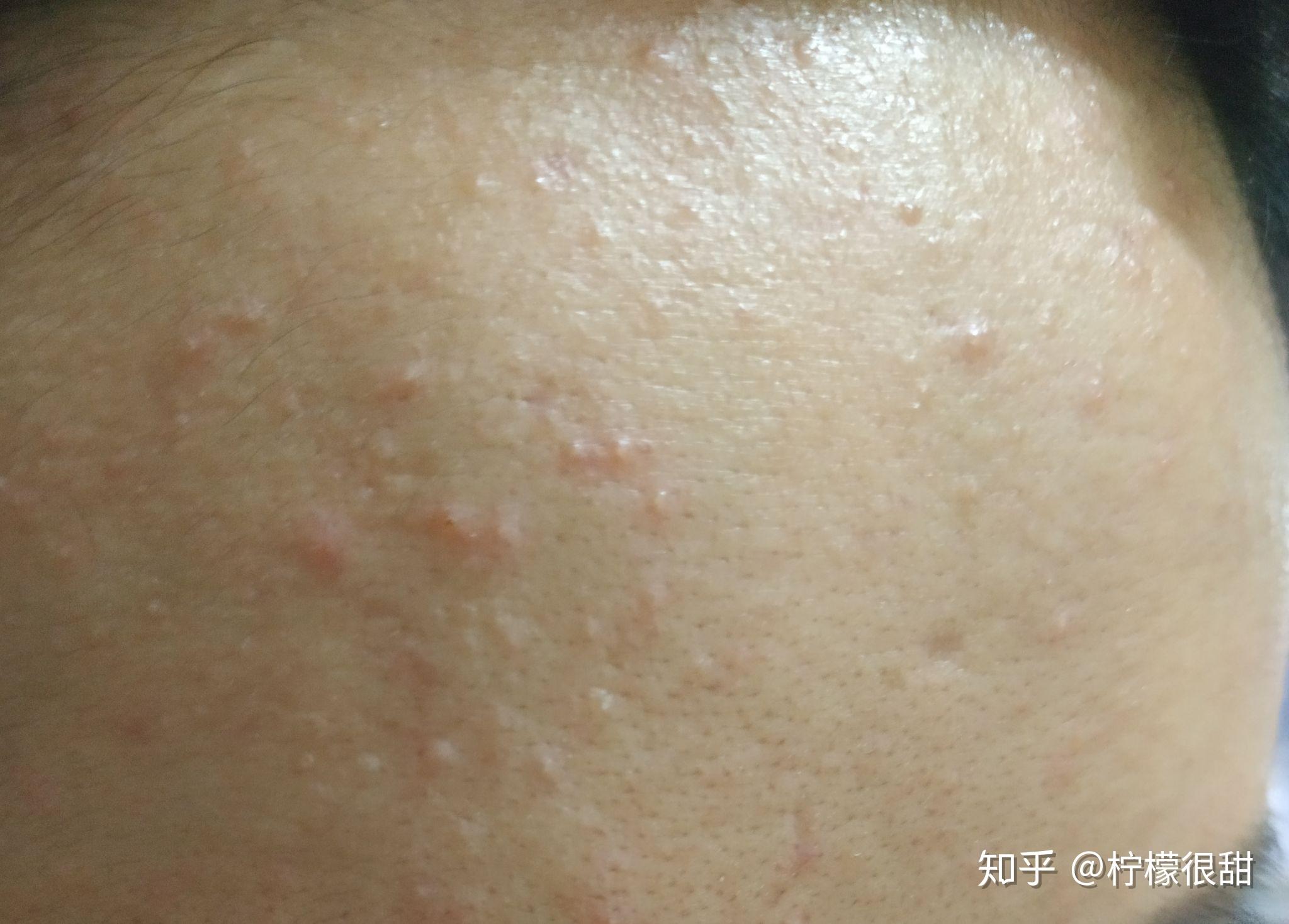 如何有效去闭口 知乎