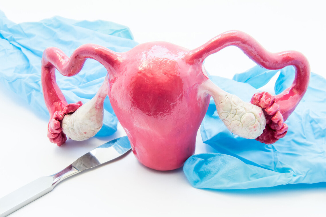 派特灵派特生物科普｜HSIL全子宫切除术治疗的最新中国专家共识 - 知乎