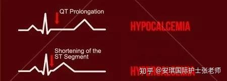 Chvostek's sign&Trousseau's sign, 这是什么体征？ - 知乎