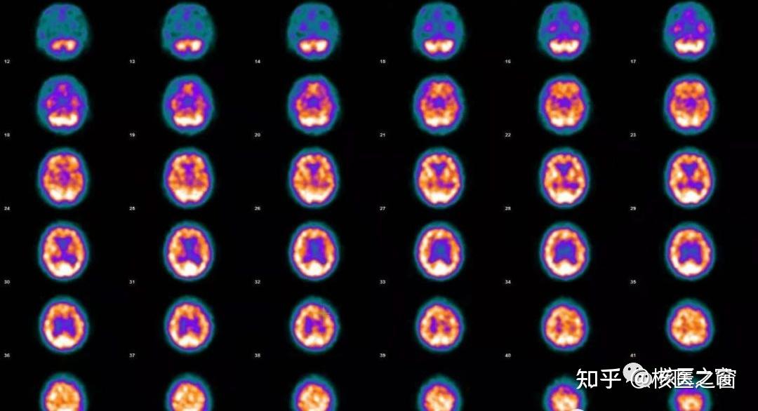 “万能核素”、“诊断专家”？来看99mTc是如何在核医学圈大展拳脚的！ - 知乎