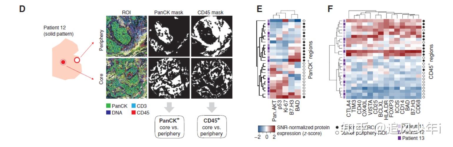 单细胞 & DSP(Digital Spatial Profiler)联合分析解析肺腺癌的转录重编程推动cancer evolution - 知乎