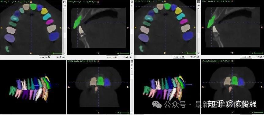 Semi-TeethSeg2024——3D CBCT 牙齿实例分割 - 知乎