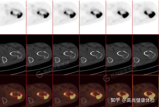 软骨肉瘤PET/CT显像一例 - 知乎