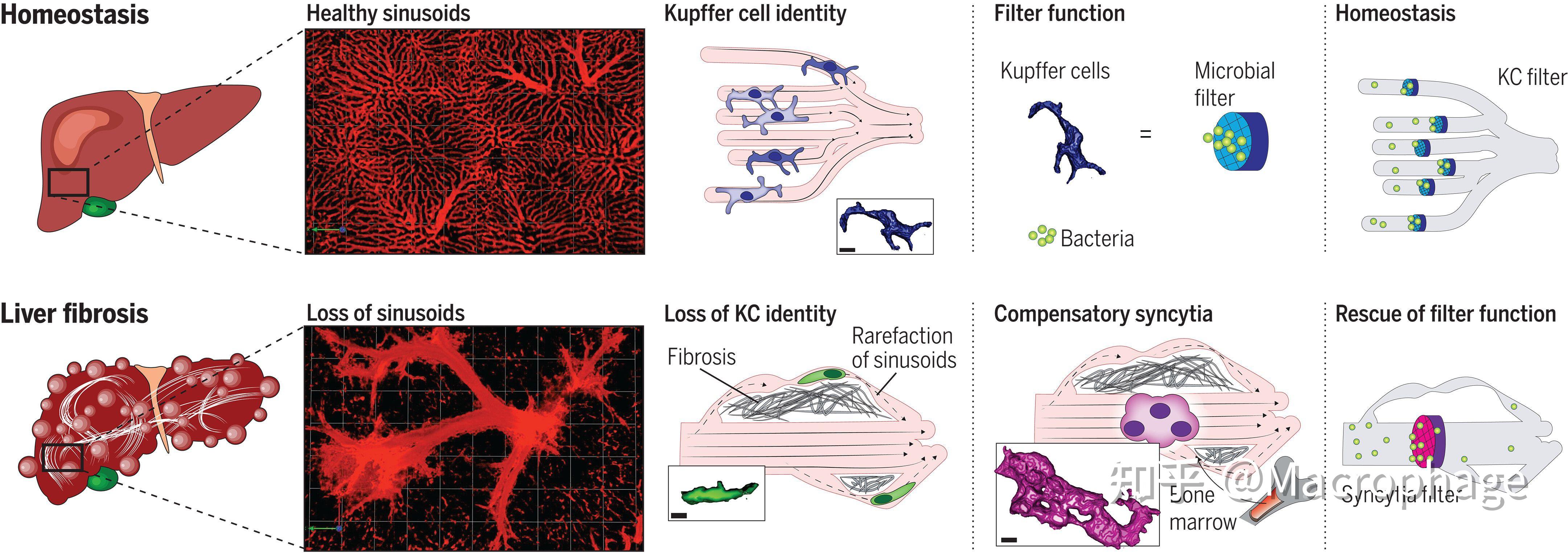 《Science》: 类Kupffer cells (KCs)细胞集群代偿补充纤维化肝脏中定居巨噬细胞的功能 - 知乎