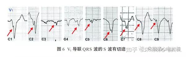 宽QRS波心动过速的鉴别诊断 - 知乎