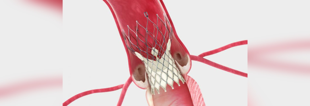 美敦力宣布FDA批准新一代TAVR系统TAVR系统治疗严重主动脉瓣狭窄 - 知乎