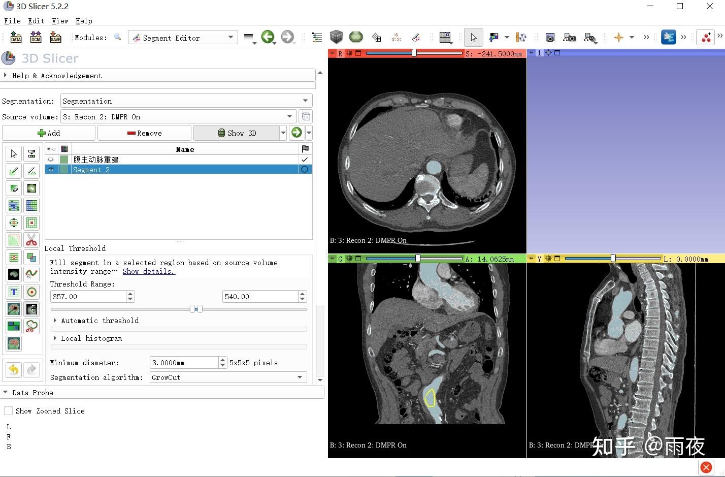 3D slicer 重建腹主动脉及髂动脉 - 知乎