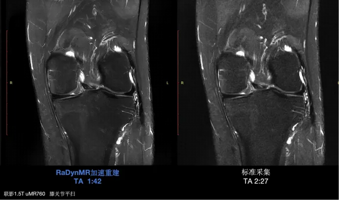 RaDynMR加速膝关节MRI扫描 - 知乎