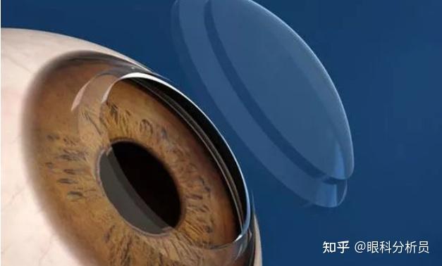 这是一期关于OK镜的干货科普，什么是OK镜？有什么好处？ - 知乎