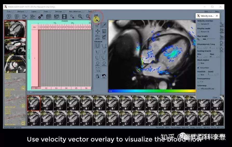 心脏磁共振技术大全（四） - 知乎