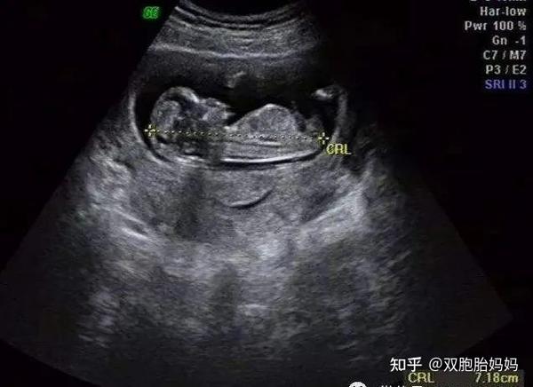 掌握基本功！一看就懂的NT测量常用解读方法，图文并茂 - 知乎