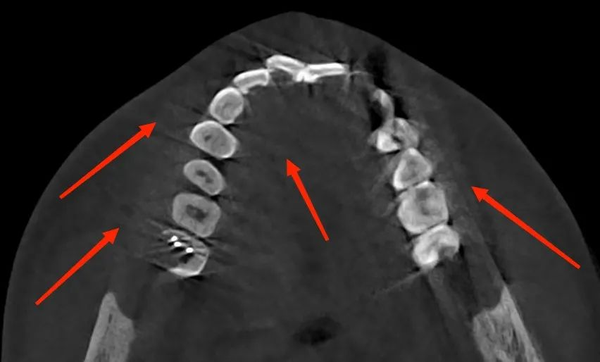 不可避免的CBCT运动伪影，到底如何改善？ - 知乎