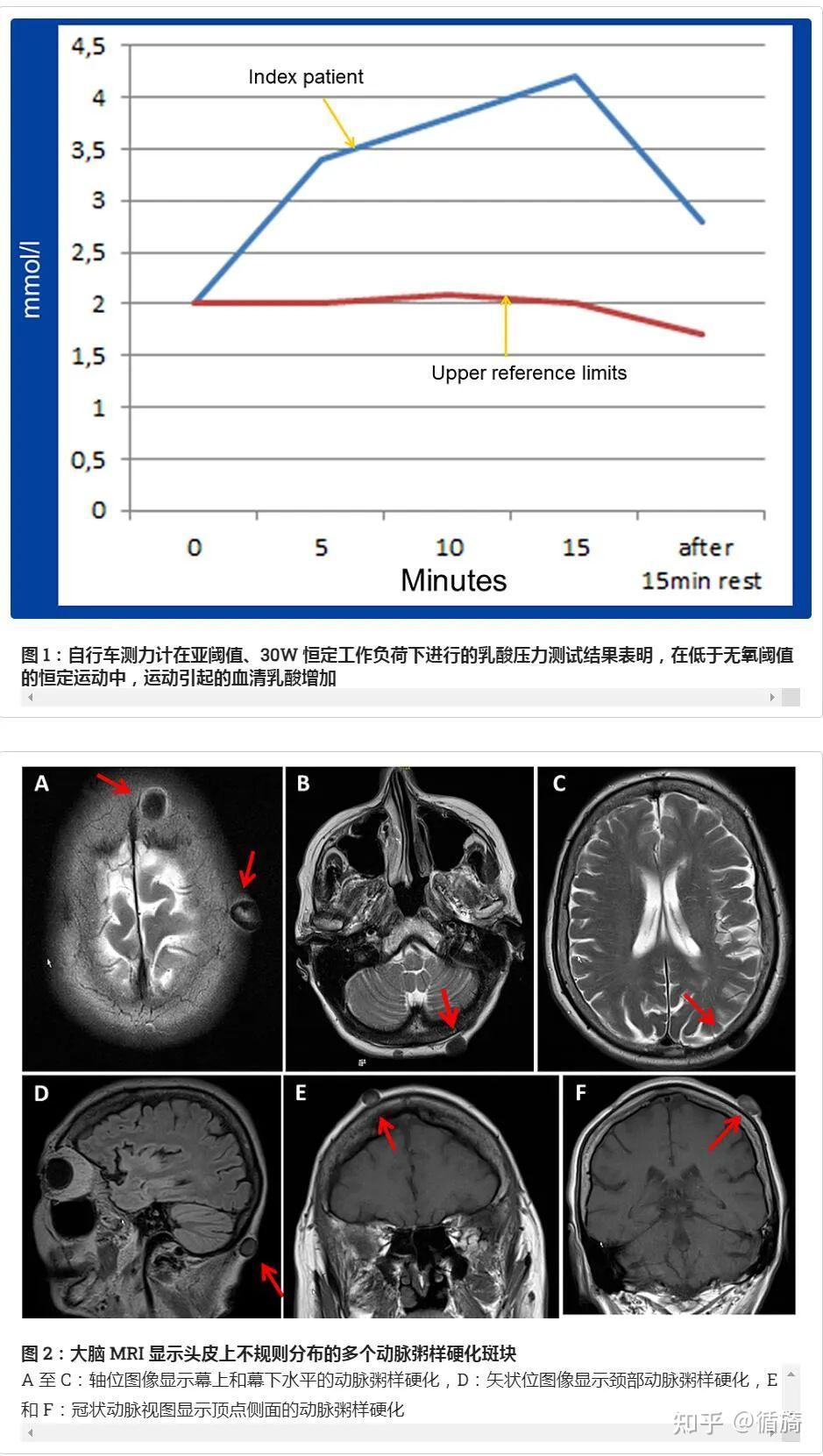 慢性进行性眼外肌麻痹 (CPEO)：引起眼睑下垂、眼球运动受限、延髓肌无力和近端肢体无力的线粒体疾病 - 知乎