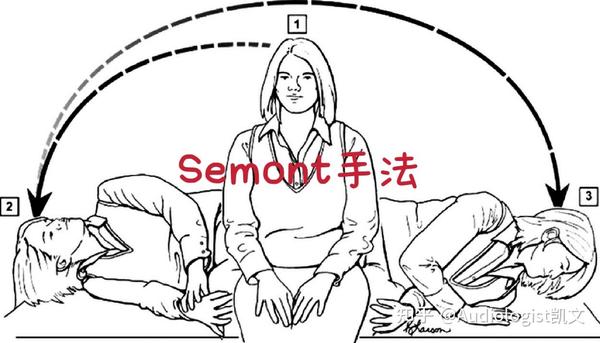 耳石症 看这篇就够了~ - 知乎