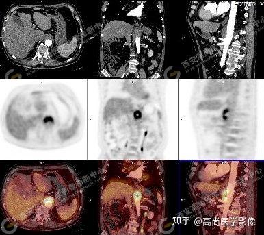 PET/CT-CTA多模态诊断穿透性动脉粥样硬化性溃疡（PAU）一例 - 知乎