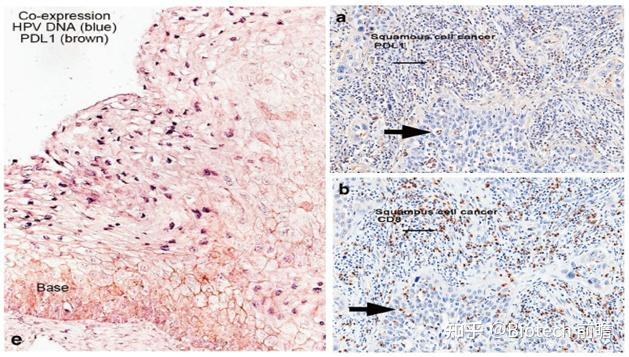 HPV感染型肿瘤免疫获益的机制研究，可摒弃PD-L1筛选？ - 知乎