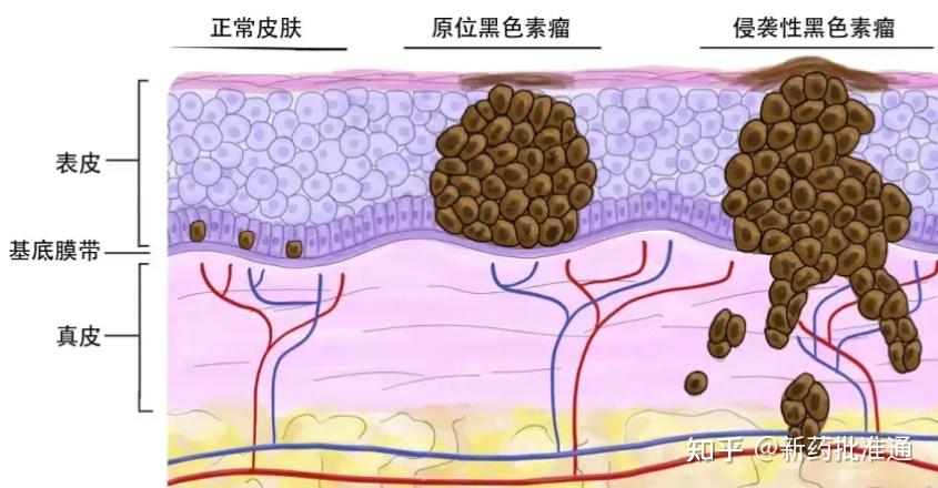 国产首款！国内自主研发MEK抑制剂获批上市【NMPA新药-妥拉美替尼】 - 知乎