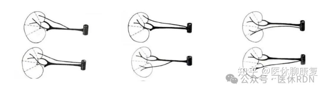 收藏！RDN一般手术操作步骤 - 知乎