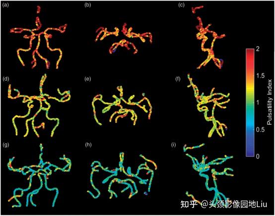一起看懂4D FLOW MRI参数（下） - 知乎