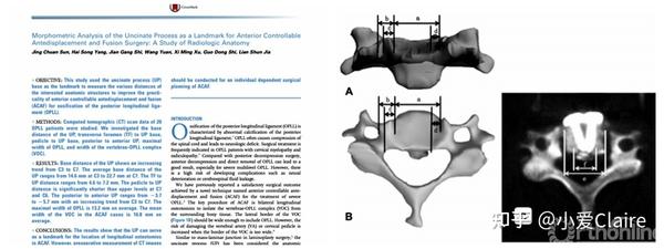 名医专访|上海长征医院脊柱外科缪锦浩：颈前路椎体骨化韧带前移融合术ACAF - 知乎
