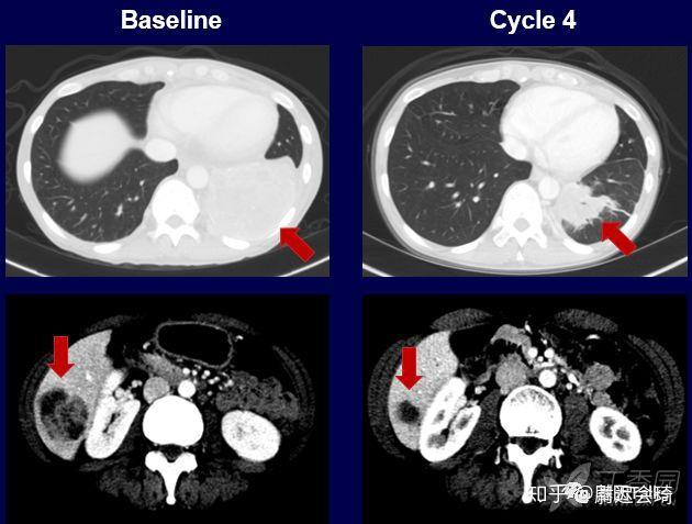 关于NTRK的一些必须了解的问题 - 知乎