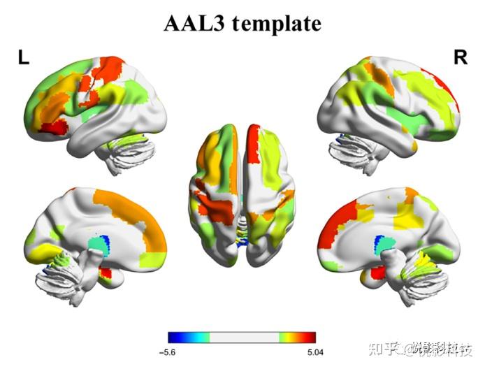 从时间变异性角度看睡眠剥夺后的异常动态功能连接 - 知乎