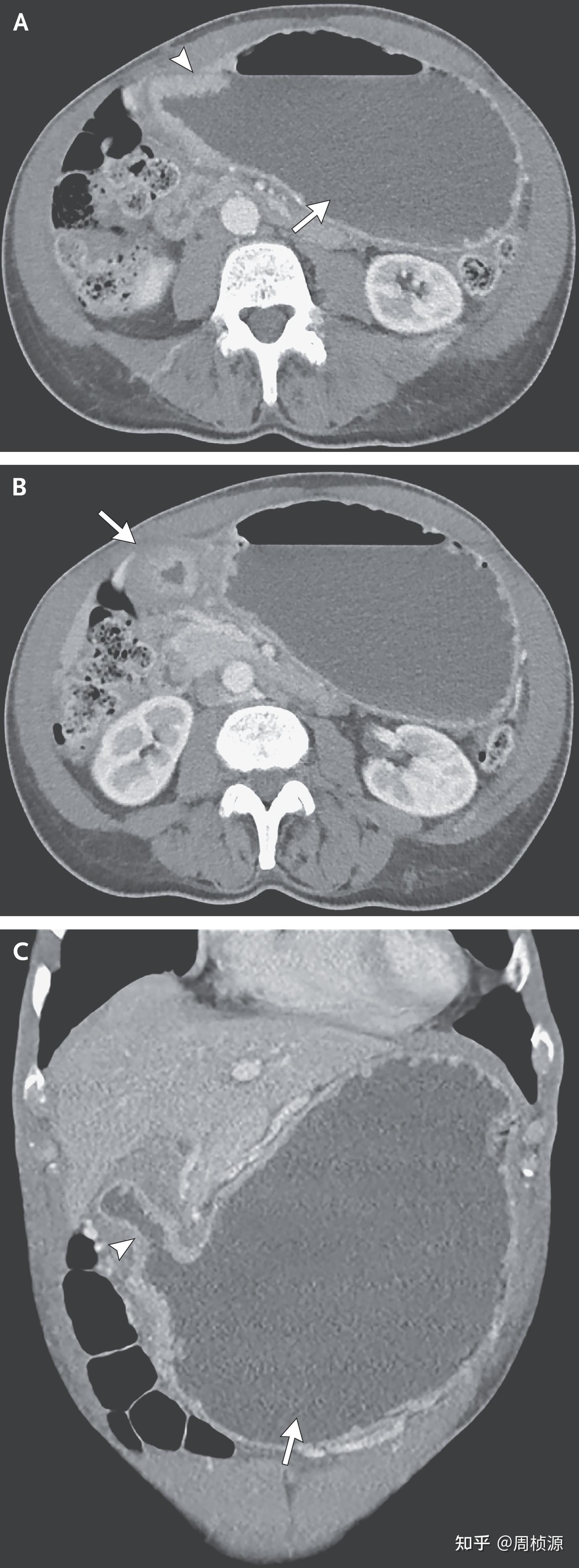 Nejm 2022 Case 31 - 知乎
